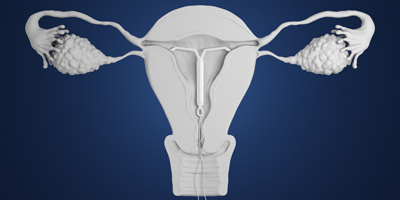 How IUDs work, the different types and what to expect during and after ...
