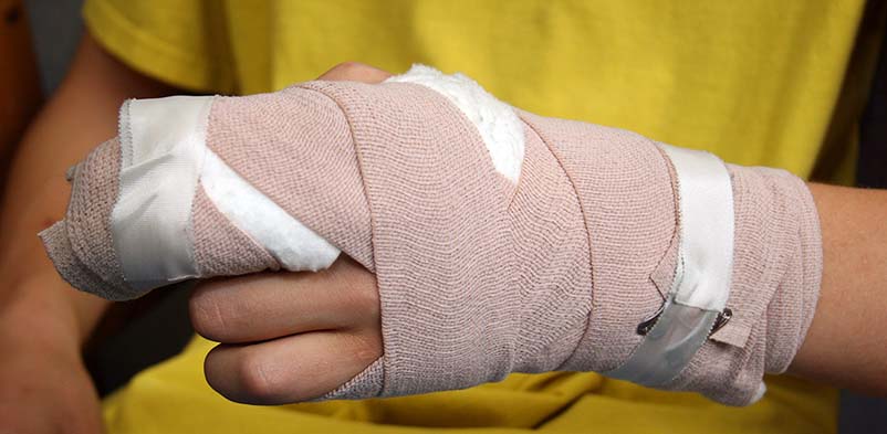Severe Hand Contusion