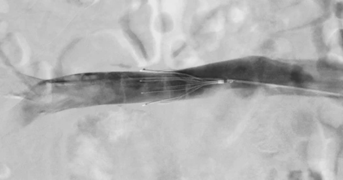 IVC filter placement and removal: A complete care approach | Nebraska ...