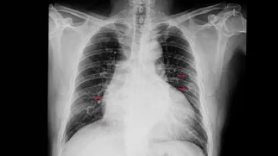 I think I broke my rib. Now what? | Nebraska Medicine Omaha, NE